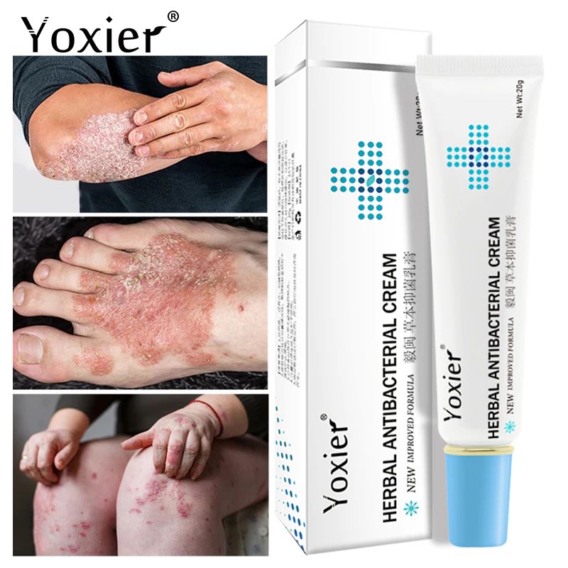 Yoxier Herbal Antibacterial Cream Psoriasis Cream Anti-Itch Relief ...