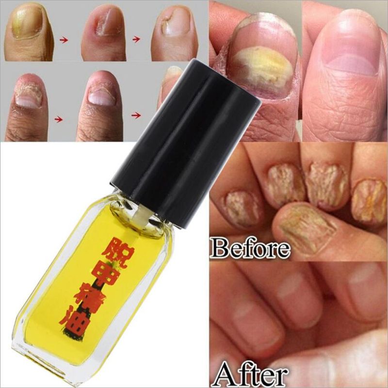 New Newest 3 Days Effect Treatment Removal Of Onychomycosis Paronychia ...